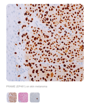 Cell Marque PRAME (EP461) Rabbit Monoclonal Primary Antibody - Abacus dx