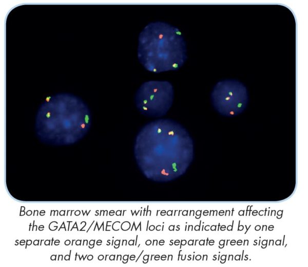 New ZytoVision ZytoLight® SPEC GATA2/MECOM Dual Colour Fusion Probe ...