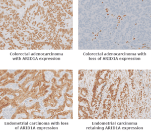 Cell Marque ARID1A (EP303) - Abacus dx