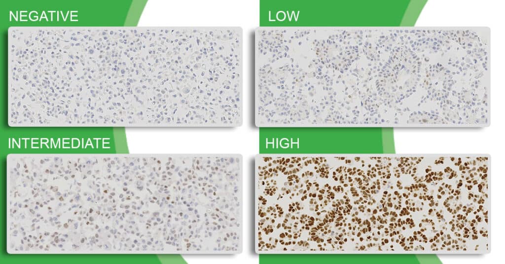 HistoCyte ER and PR Dynamic Range Analyte Controls - Abacus dx