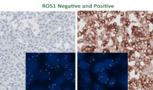 HistoCyte ROS1 Analyte Controls - Abacus dx