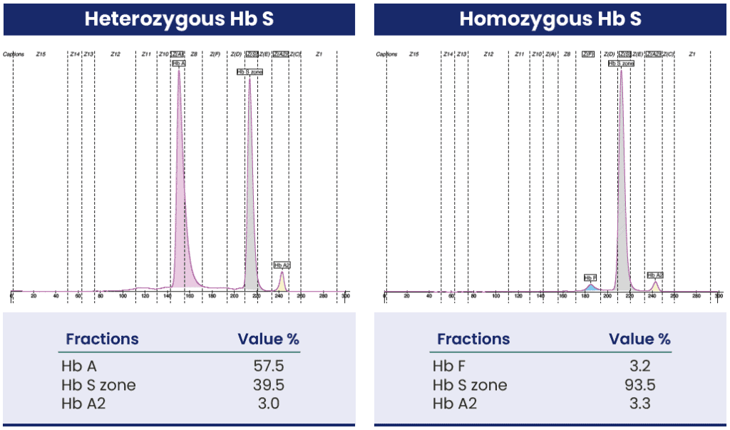 Sebia - high-resolution haemoglobin screening method - Abacus dx