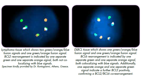 FlexISH ® BCL2/BCL6 DistinguISH™ Probe* - Abacus dx